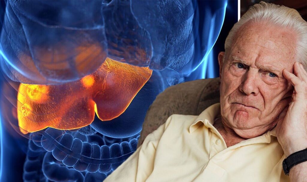 Siroz Nedir? Belirtileri ve Tedavi Yöntemleri - Gammaz